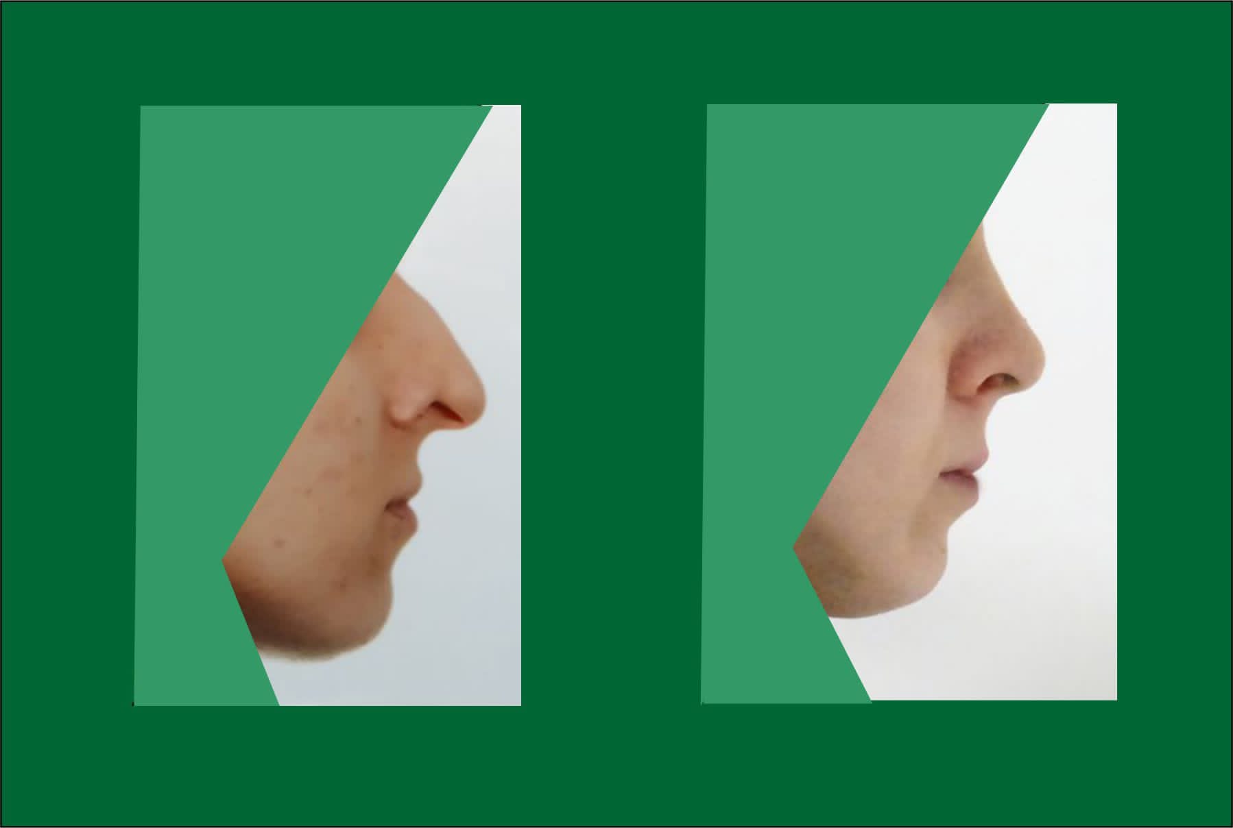 Operacja nosa Katowice Śląsk - Korekcja nosa cena